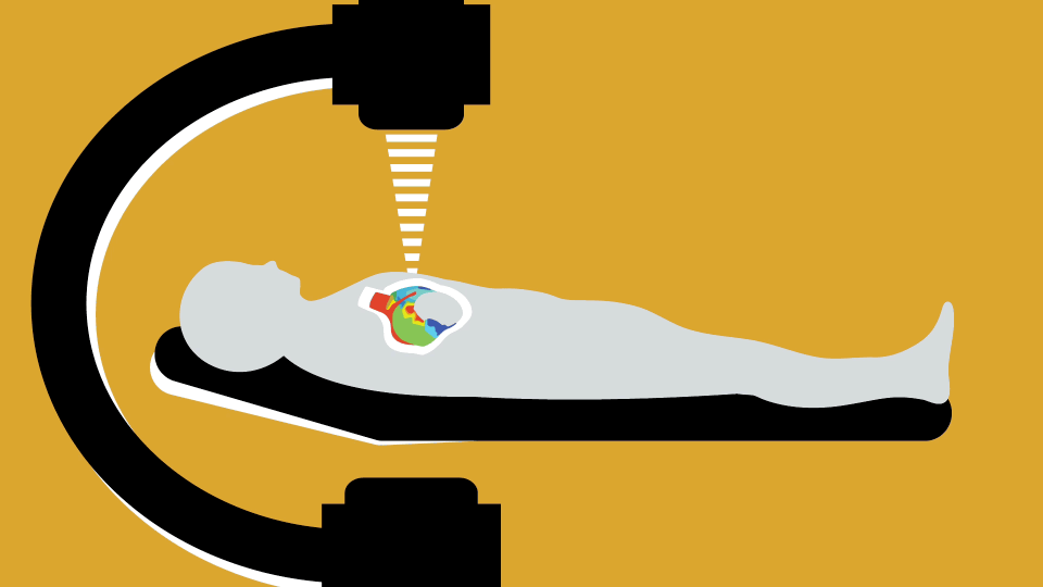 Radiation beam to the heart - Outlook Magazine