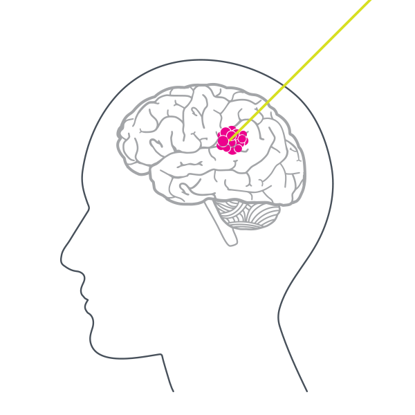 Brain tumors: Fighting with targeted tools - Outlook Magazine